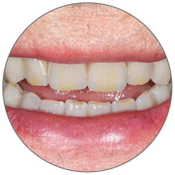 VITA PHYSIODENS | Premium denture tooth for natural esthetics and function